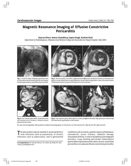 Magnetic Resonance Imaging of Effusive Constrictive Pericarditis