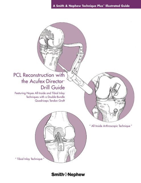 PCL Reconstruction with the AcufexÂ® Directorâ ¢ Drill Guide
