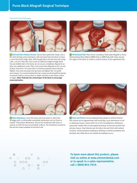 Puros Block Allograft Surgical Technique - Zimmer Dental