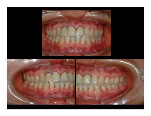 Classification System for the Completely Dentate Patient