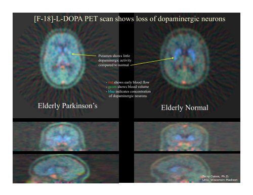 [F-18]-L-DOPA PET scan shows loss of dopaminergic neurons