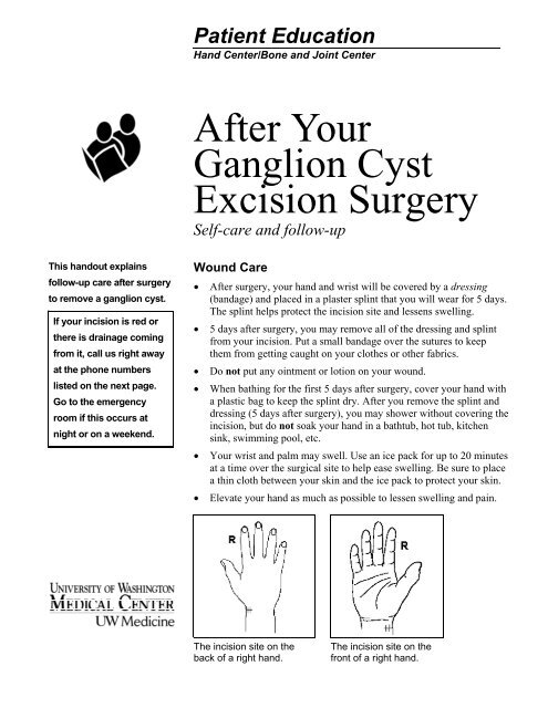 Ganglion Cyst Excision - UWMC Health On-Line - University of ...