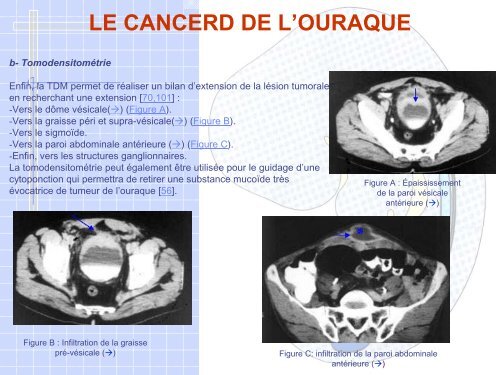 LE CANCERD DE L’OURAQUE