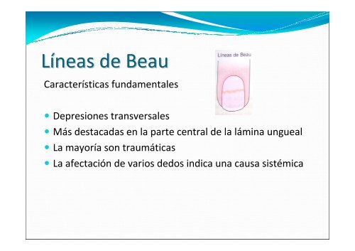 Líneas de Beau y onicoma