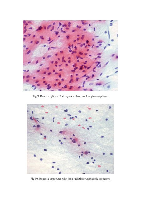 Fig 9. Reactive gliosis.