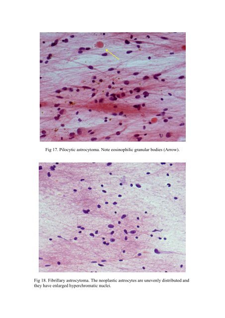 Fig 17. Pilocytic astrocy
