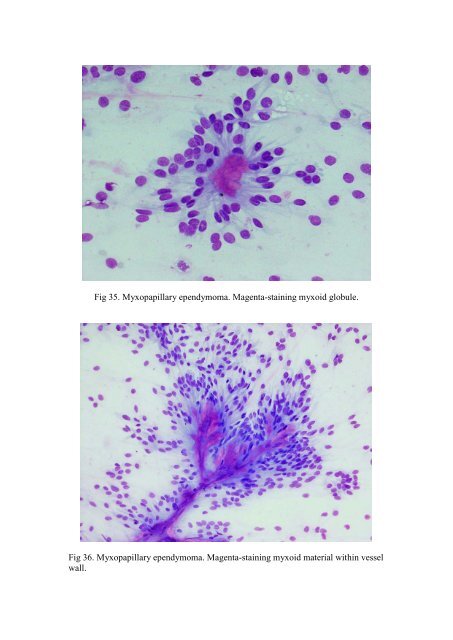 Fig 33. Ependymoma. Note