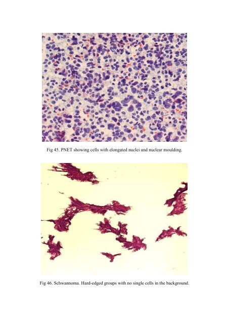 Fig 45. PNET showing cell