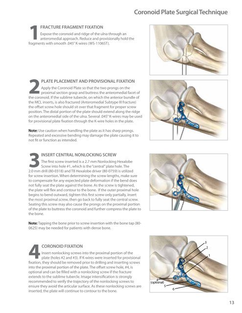Posterolateral Plate Surg