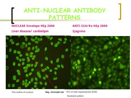 anti-nuclear antibody patterns - Rcpa.tv