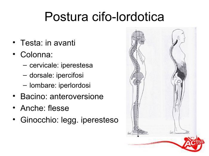 Postura Lordotica Personal, A Postura Cifótica Lordótica é Um Dos