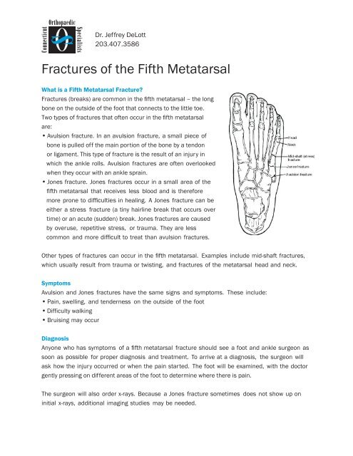 Fractures of the Fifth Metatarsal - CT-Ortho.com