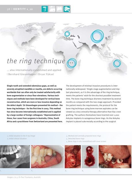 the ring technique ... - DENTSPLY Friadent