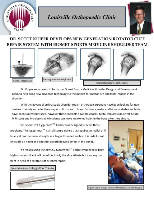 New Generation Rotator Cuff Repair System - Scott D. Kuiper, M.D.