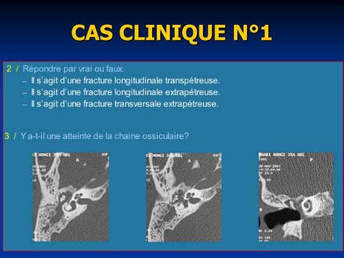 Fracture Du Rocher Photos: Fracture Du Rocher Conséquence – SQMKS