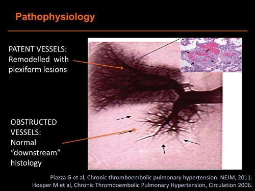 Group 4: CTEPH• Most