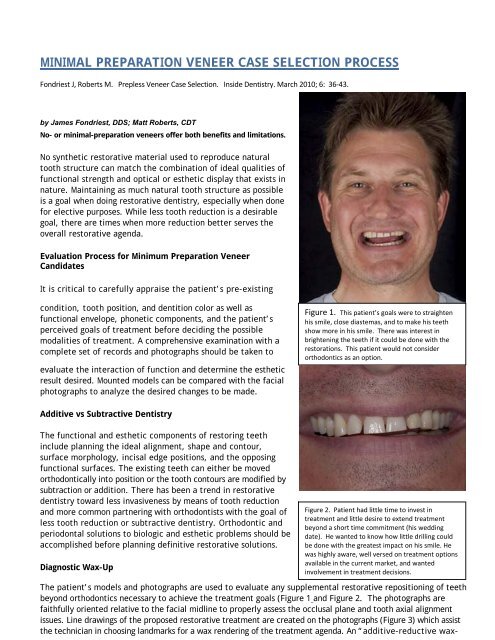 MINIMAL PREPARATION VENEER CASE SELECTION PROCESS