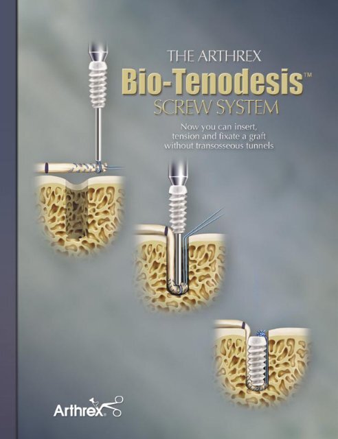 Bio-Tenodesis Screw System Implants, sterile, single use