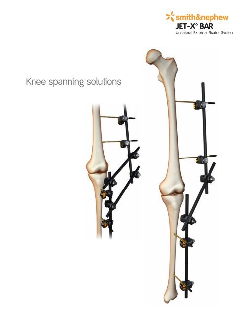 Knee spanning solutions - Osteosyntese