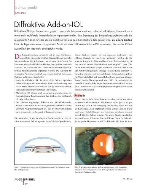 Diffraktive Add-on-IOL