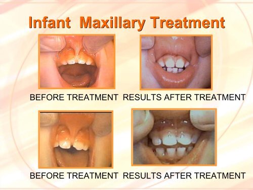 Infant Maxillary