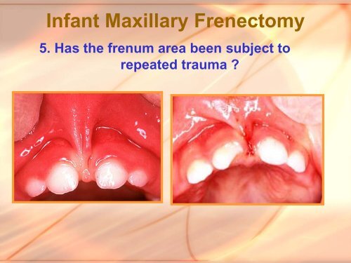 Infant Maxillary