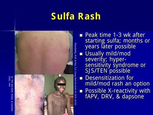 Sulfa Rash