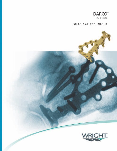 CPS Plate SURGICAL TECHNIQUE - Osteosyntese