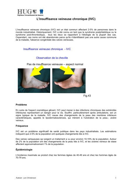L'insuffisance veineuse chronique (IVC) - HUG