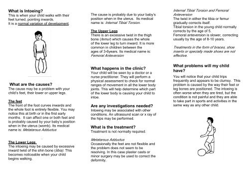What is Intoeing? - University Hospital Southampton NHS ...
