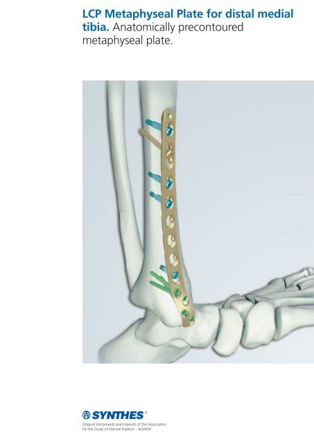 LCP Metaphyseal Plate for distal medial tibia ... - Osteosyntese