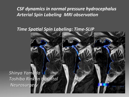 CSF dynamics in normal pressure hydrocephalus Arterial Spin ...