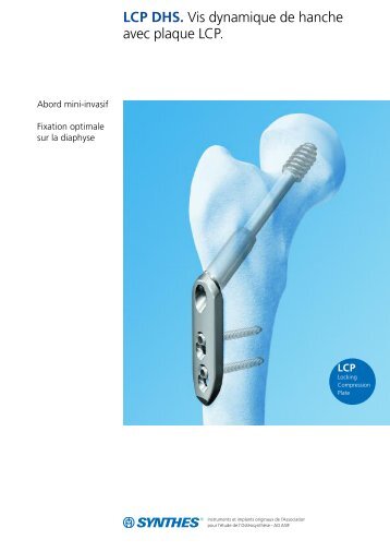 Système DHS/DCS. Incluant LCP DHS et lame DHS. - Synthes