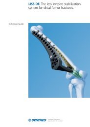 TomoFix Medial Distal Femur (MDF) - Synthes