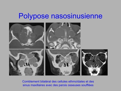 Polypose nasosinu