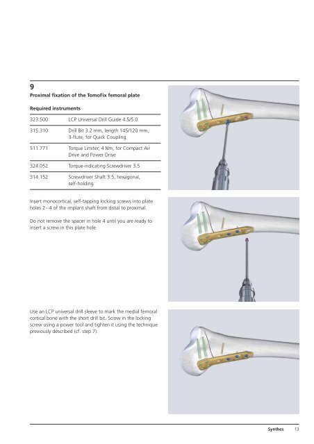 9Proximal fixation of the