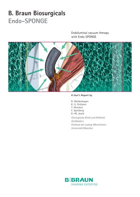 B. Braun Biosurgicals Endo-SPONGE