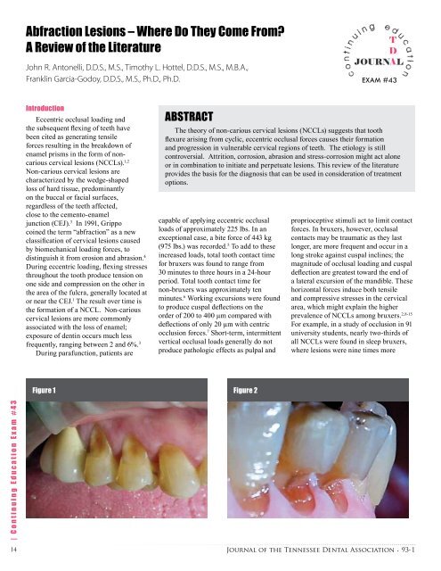 Tooth Abfraction Treatment