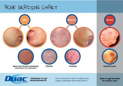 Diagrama De Acne Nodular