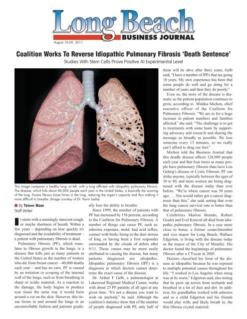 Coalition Works To Reverse Idiopathic Pulmonary Fibrosis 'Death ...