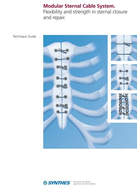 Modular Sternal Cable System - Synthes