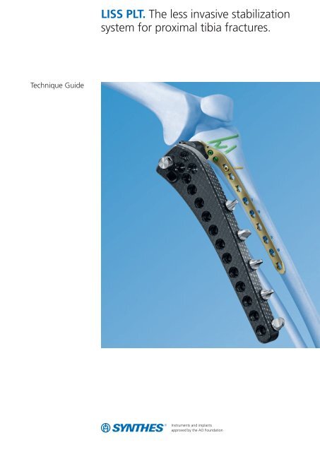 LISS Proximal Lateral Tibia - Synthes