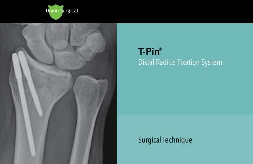 T-Pin Â® - Union Surgical