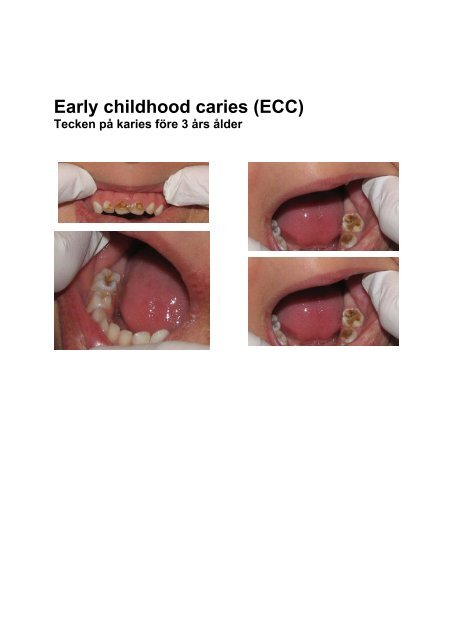 Early childhood caries (ECC)