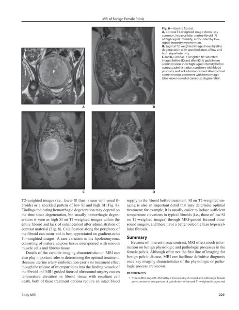 MRI