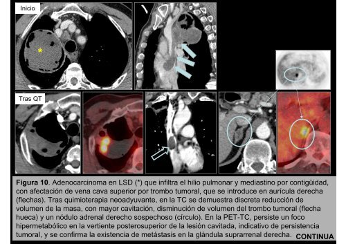 Figura 10. Adenocarcinoma en LSD (*) que infiltra el hilio pulmonar ...