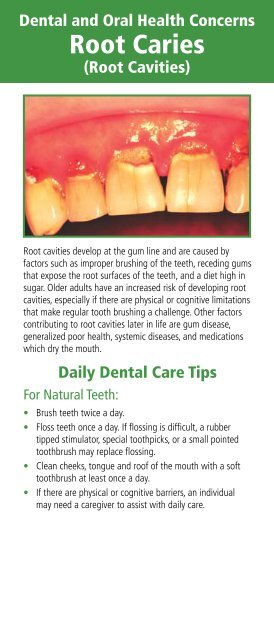 Root Caries