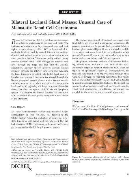 Bilateral Lacrimal Gland Masses - Dr. Yadro Ducic, Fort Worth