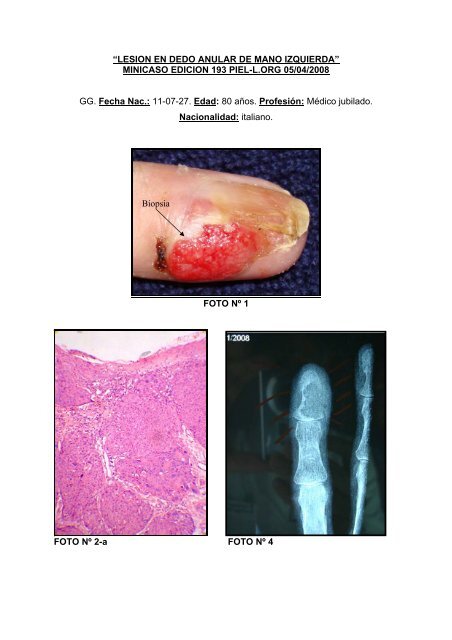 lesion en dedo anular de mano izquierda - PIEL-L Latinoamericana