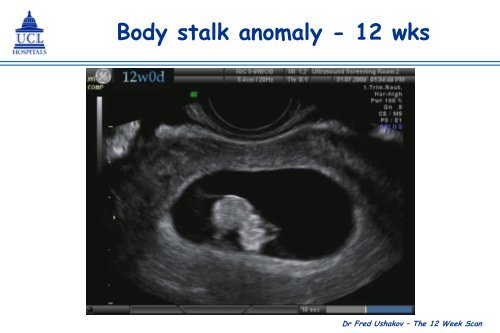 Body stalk anomaly